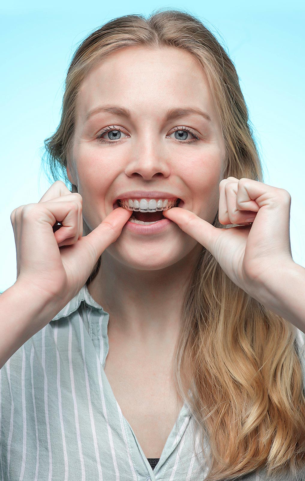 AirSmile | Overbeet corrigeren met AirSmile® - AirSmile